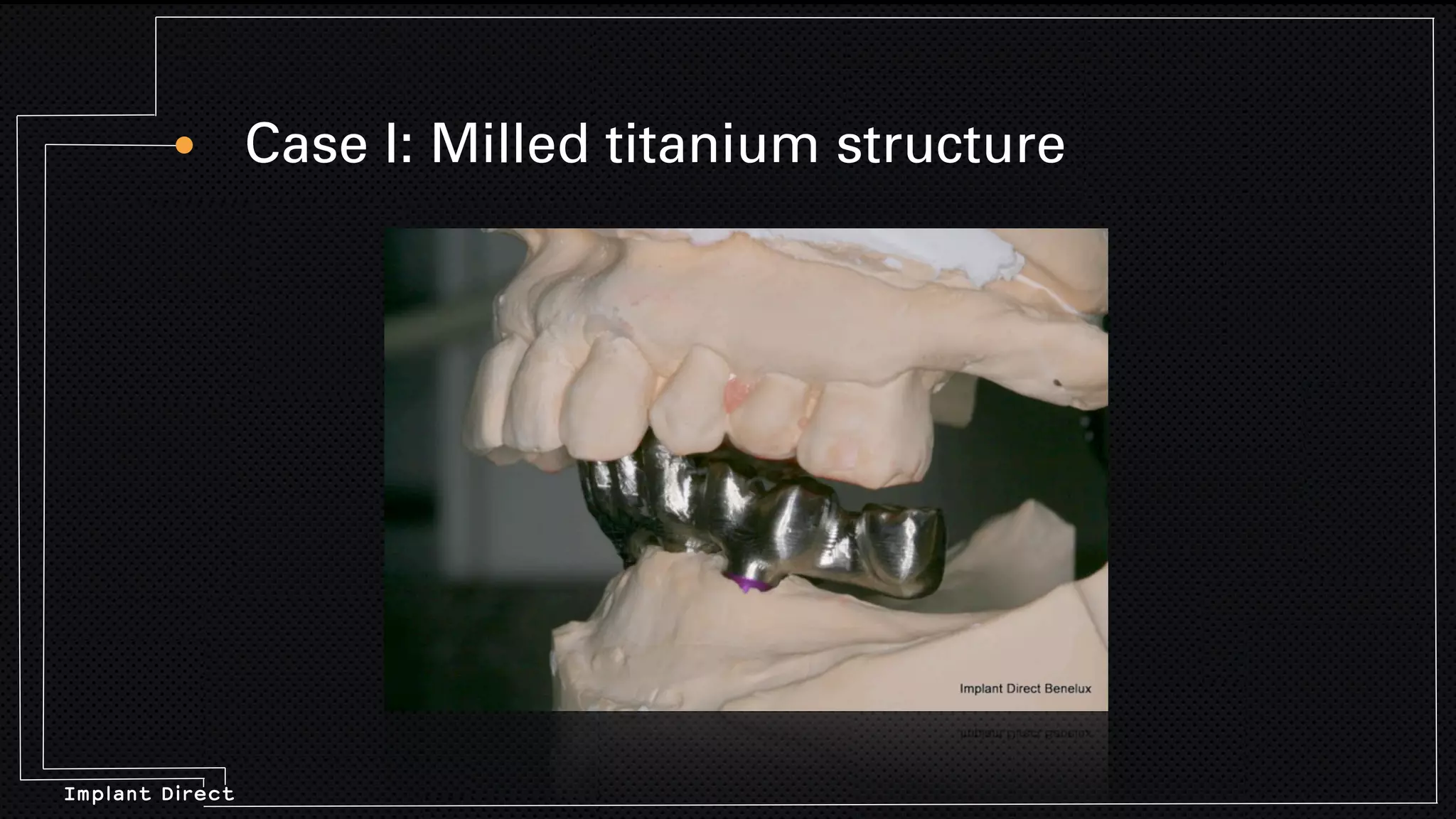 Titanium CAD Bridges with composite | PDF