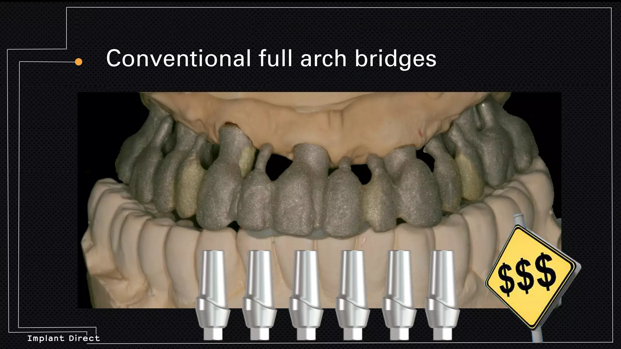 Titanium CAD Bridges with composite | PDF