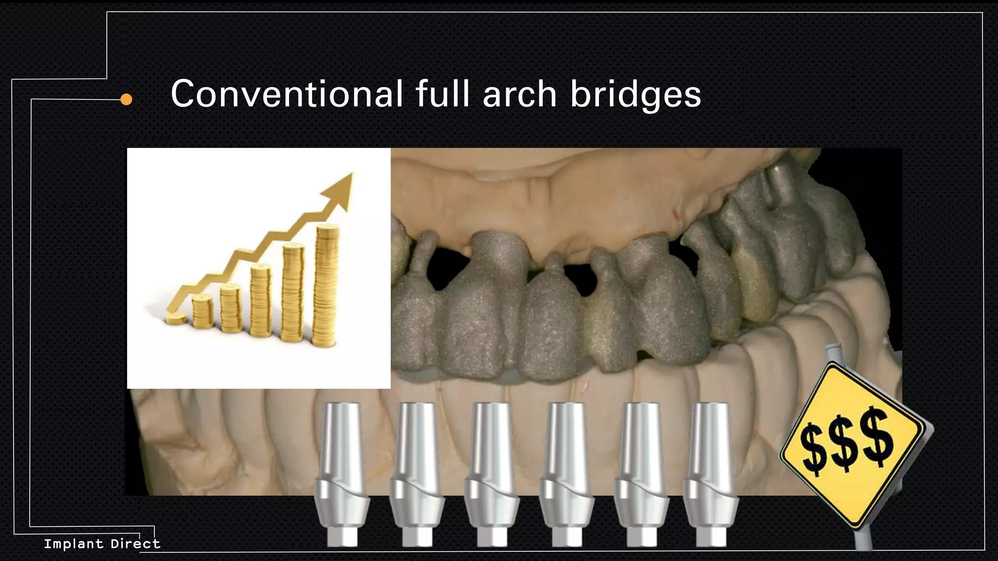 Titanium CAD Bridges with composite | PDF