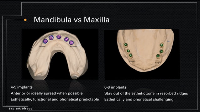 Titanium CAD Bridges with composite | PDF