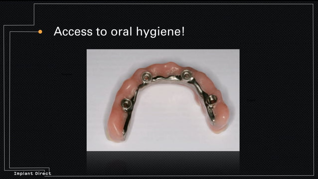 Titanium CAD Bridges with composite | PDF