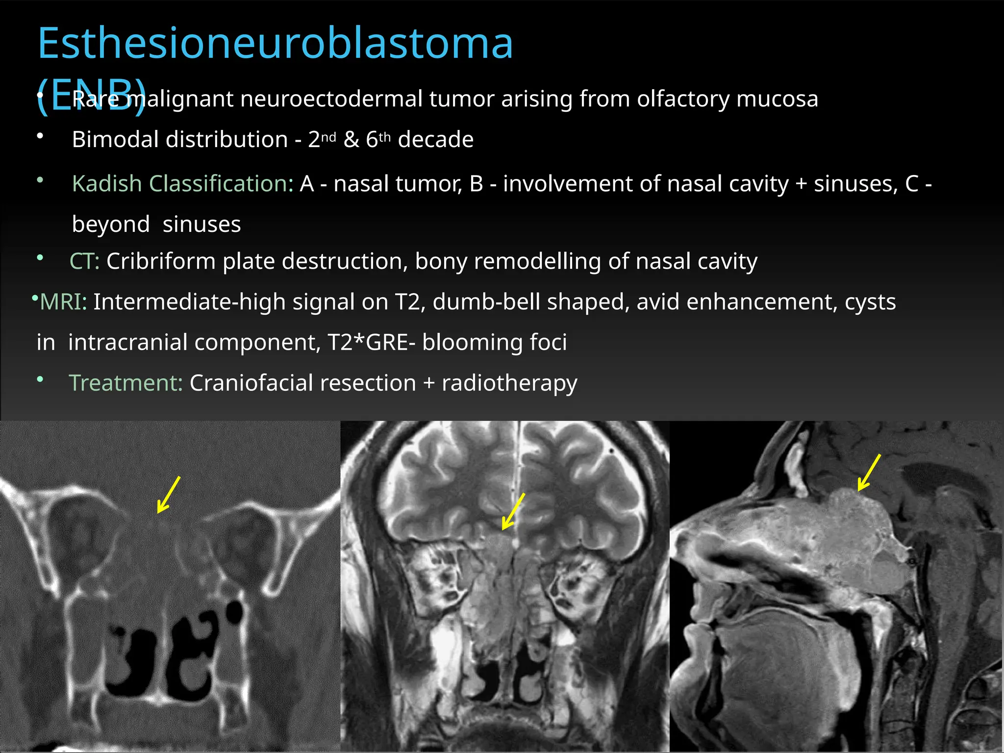 Mundada_Paranasal-sinuses-Neoplastic-lesions.pptx