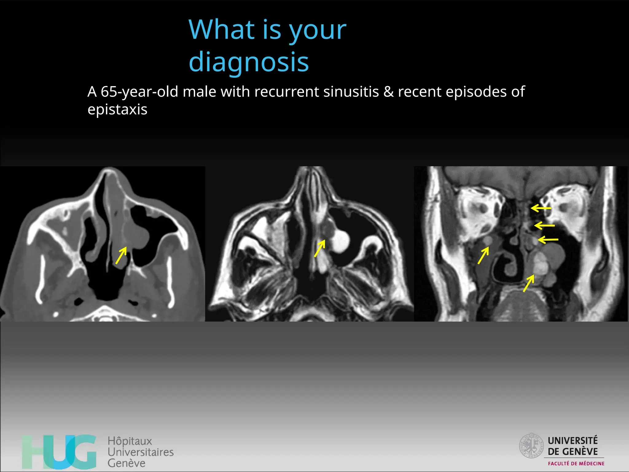 Mundada_Paranasal-sinuses-Neoplastic-lesions.pptx