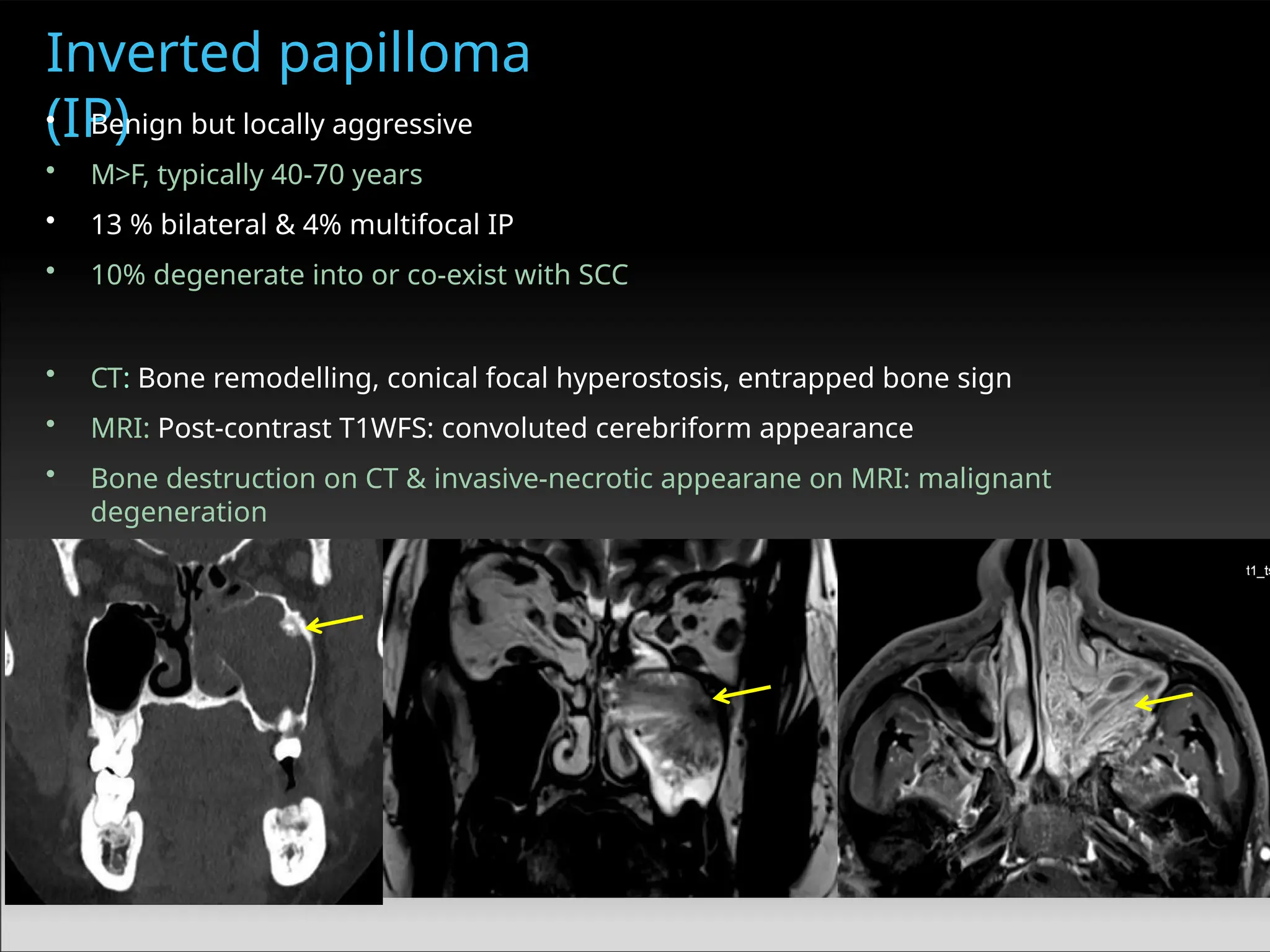 Mundada_Paranasal-sinuses-Neoplastic-lesions.pptx