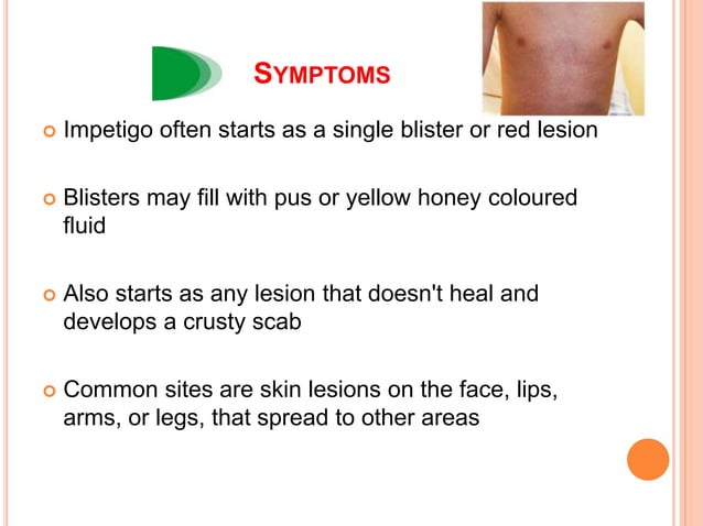 Mupirocin | PPTX | Infectious Diseases | Diseases and Conditions