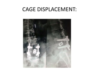 SPONDYLOLYSTHESIS | PPTX