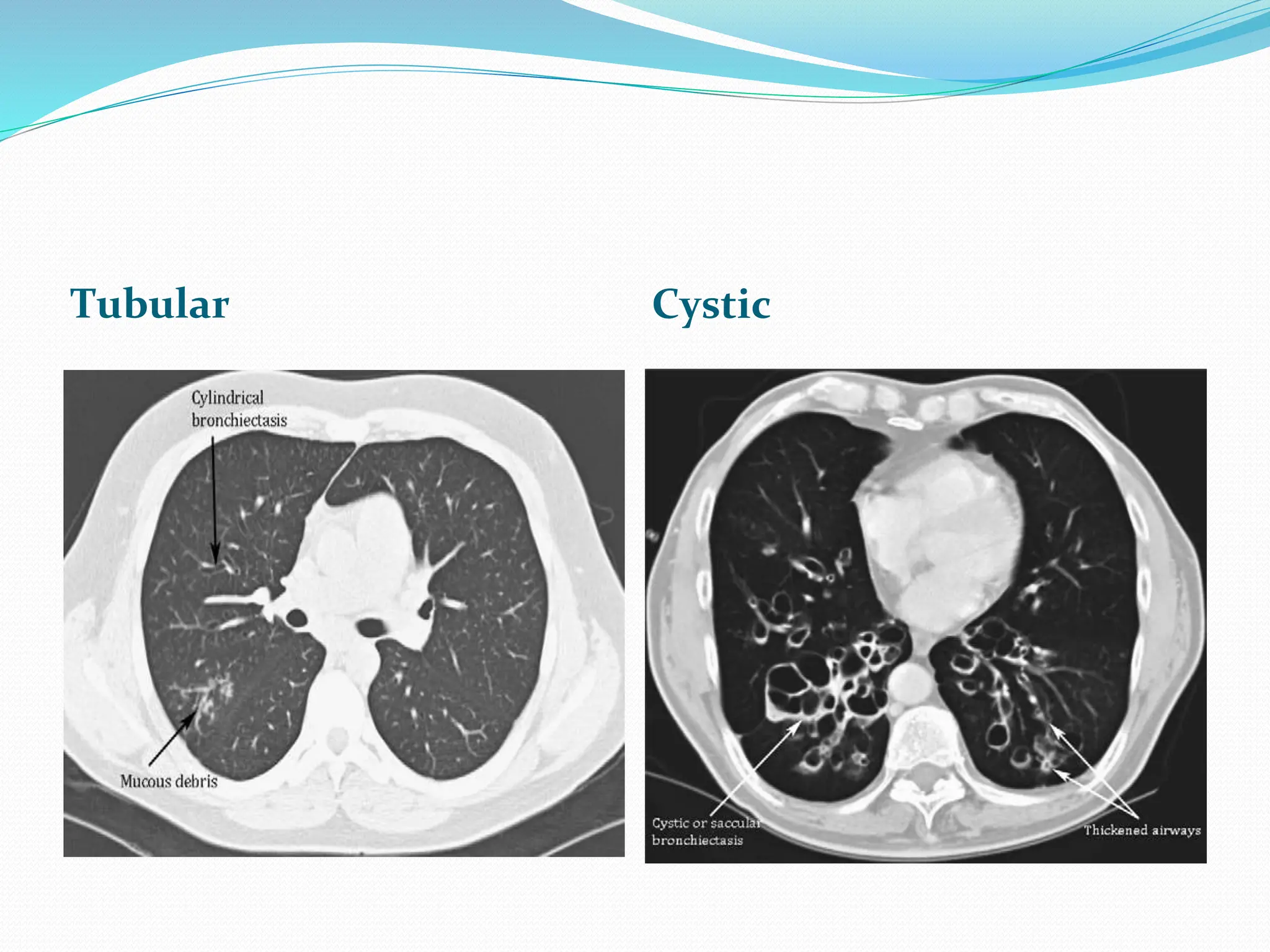 Murali bronchiectasis.pptx
