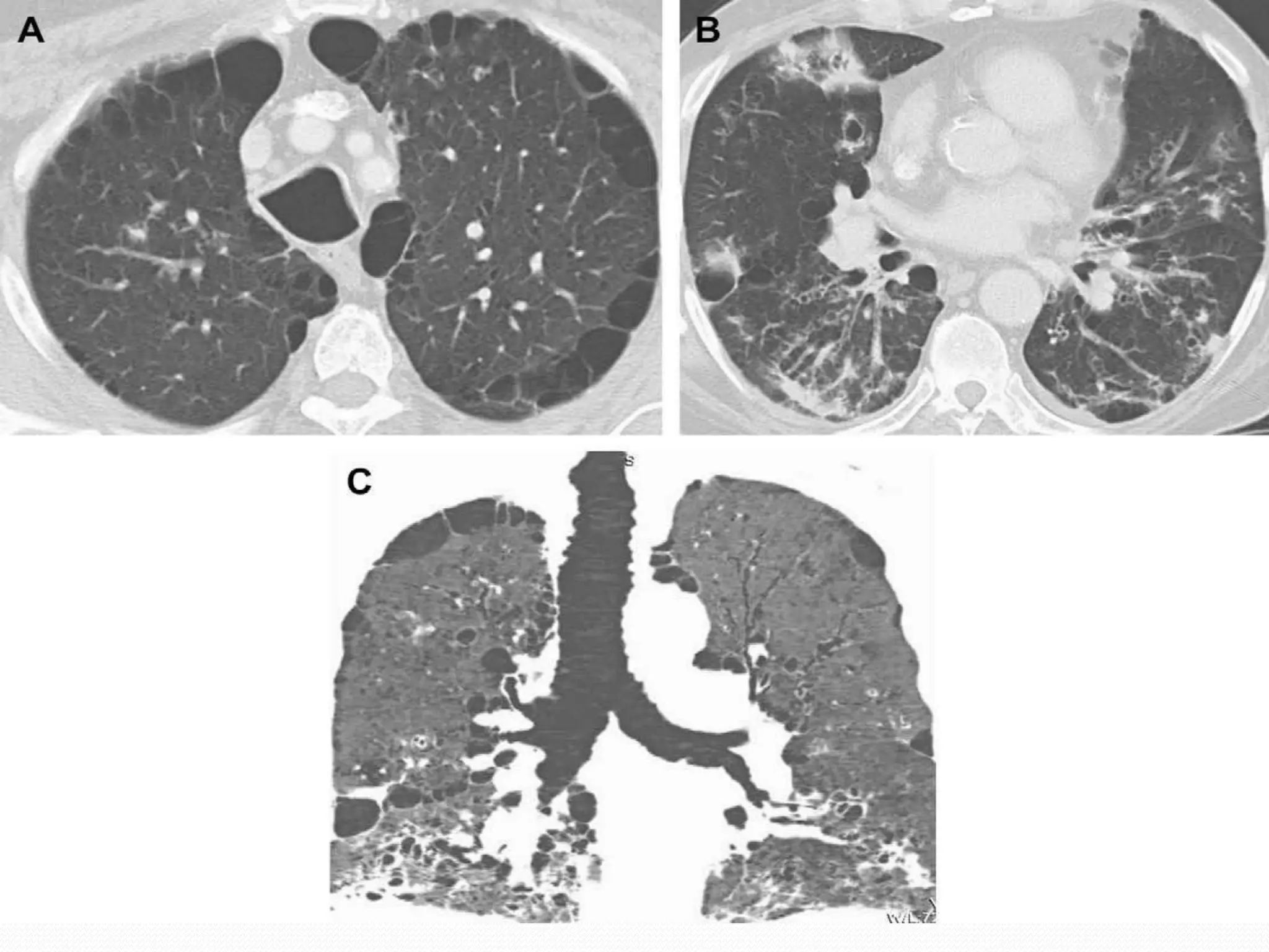 Murali bronchiectasis.pptx