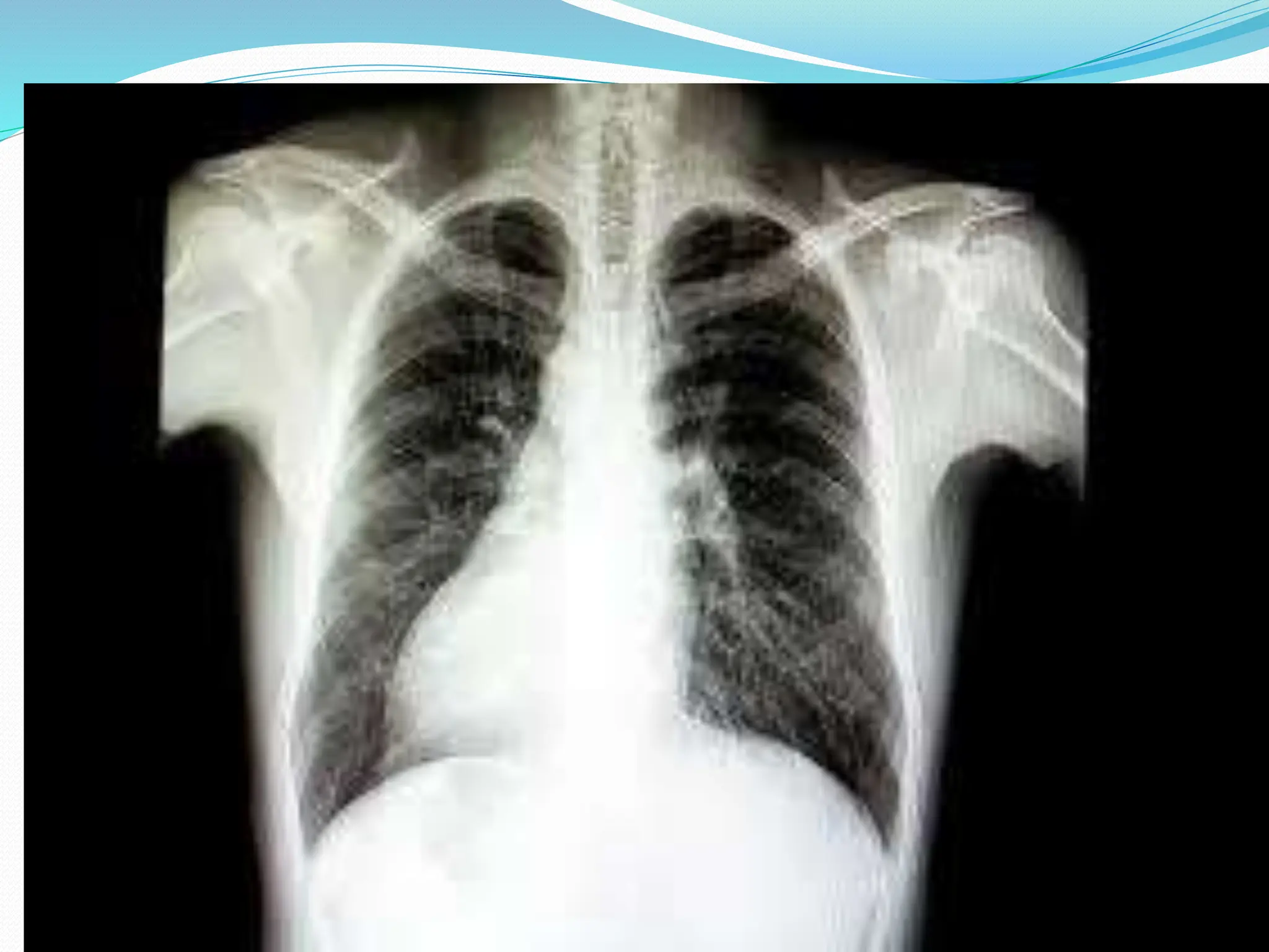 Murali bronchiectasis.pptx