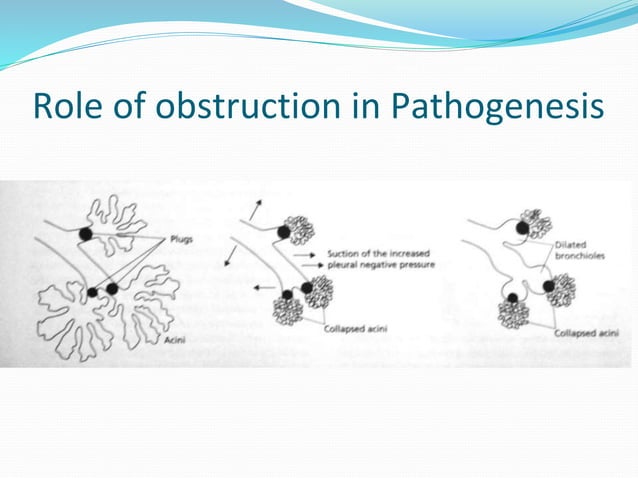 Murali bronchiectasis.pptx