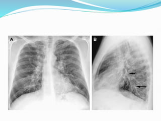 Murali bronchiectasis.pptx