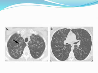 Murali bronchiectasis.pptx