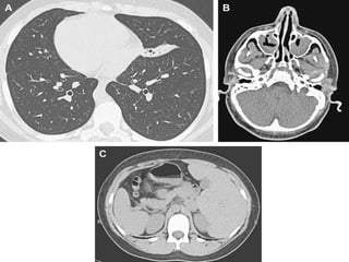 Murali bronchiectasis.pptx
