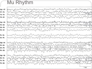 Mu rhythm | PPT
