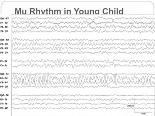 Mu rhythm | PPT