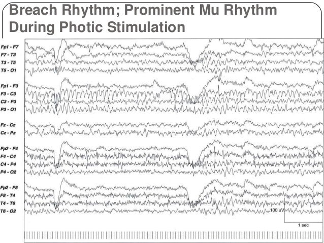 Mu rhythm
