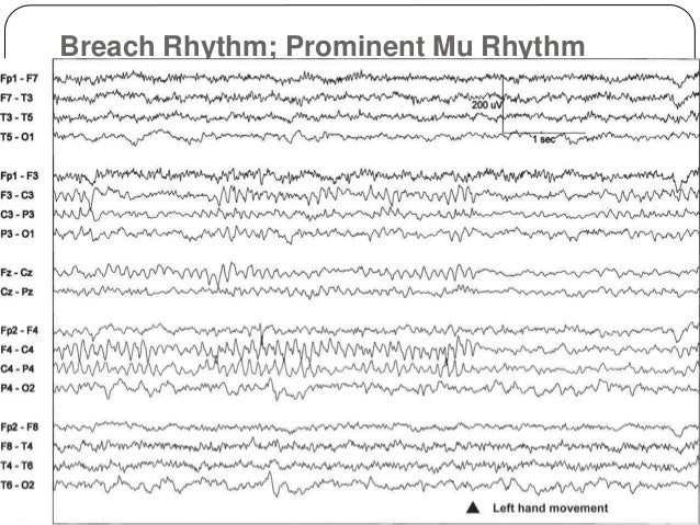 Mu rhythm