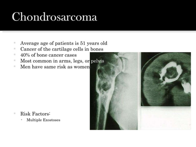 Bone Cancer | PPT | Bone and Joint Conditions | Diseases and Conditions