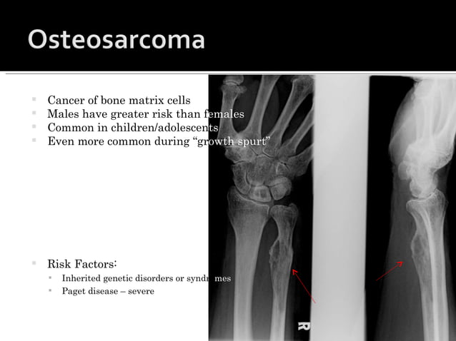 Bone Cancer | PPT | Bone and Joint Conditions | Diseases and Conditions
