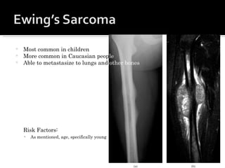 Bone Cancer | PPT