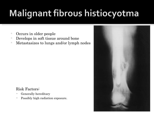 Bone Cancer | PPT | Bone and Joint Conditions | Diseases and Conditions