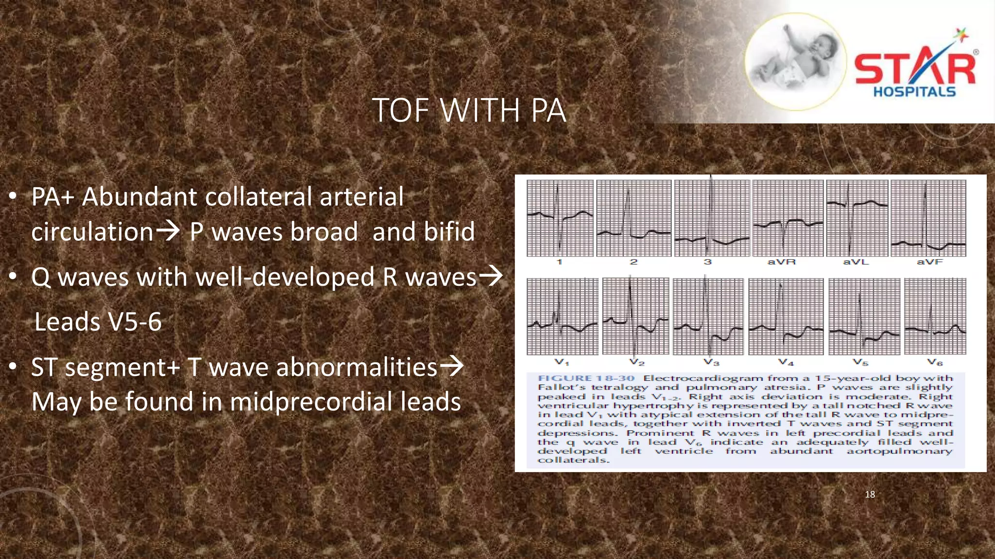 PEDIATRIC ECG, ECG IN CONGENITAL HEART DISEASES | PPTX