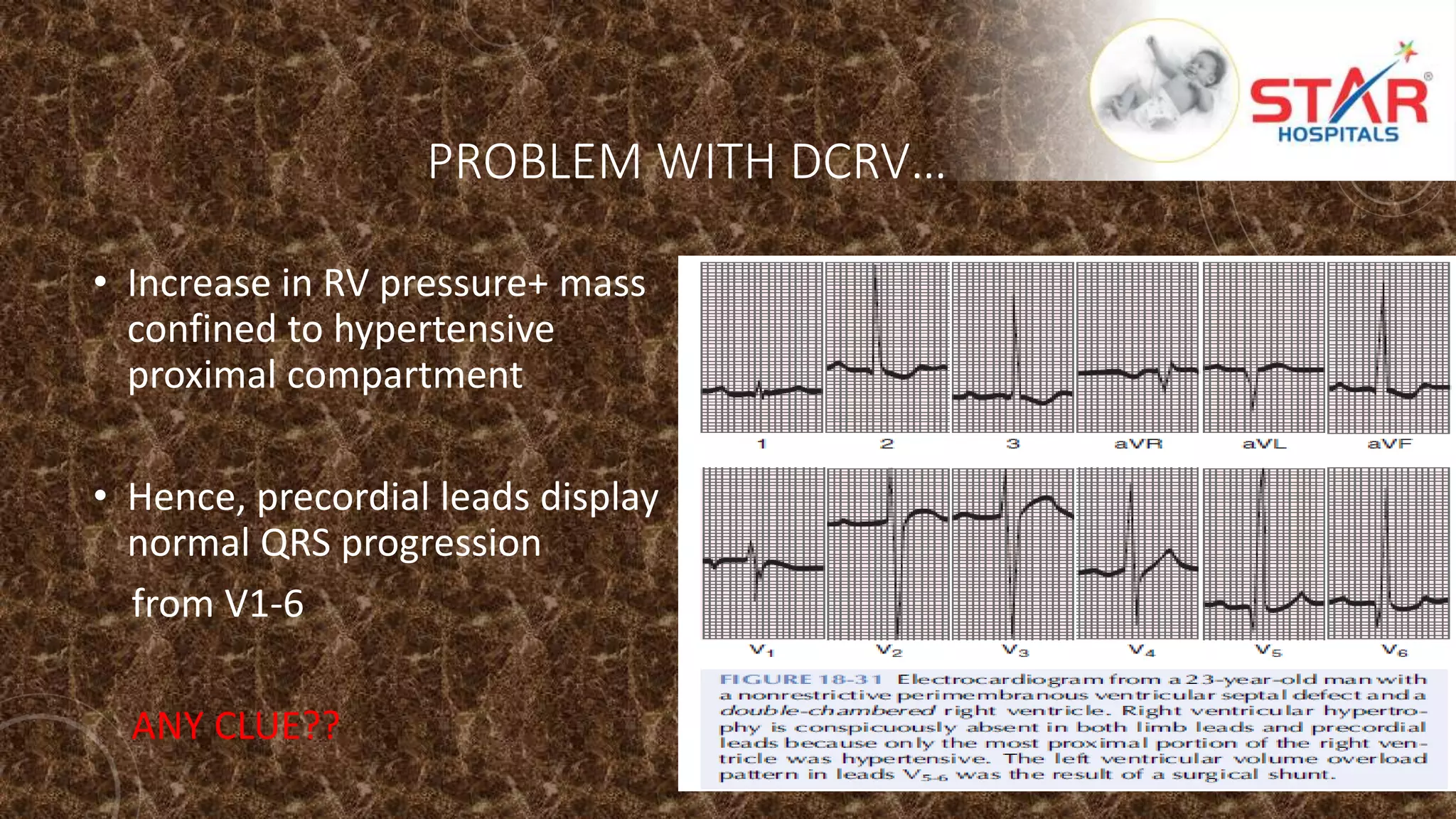 PEDIATRIC ECG, ECG IN CONGENITAL HEART DISEASES | PPTX