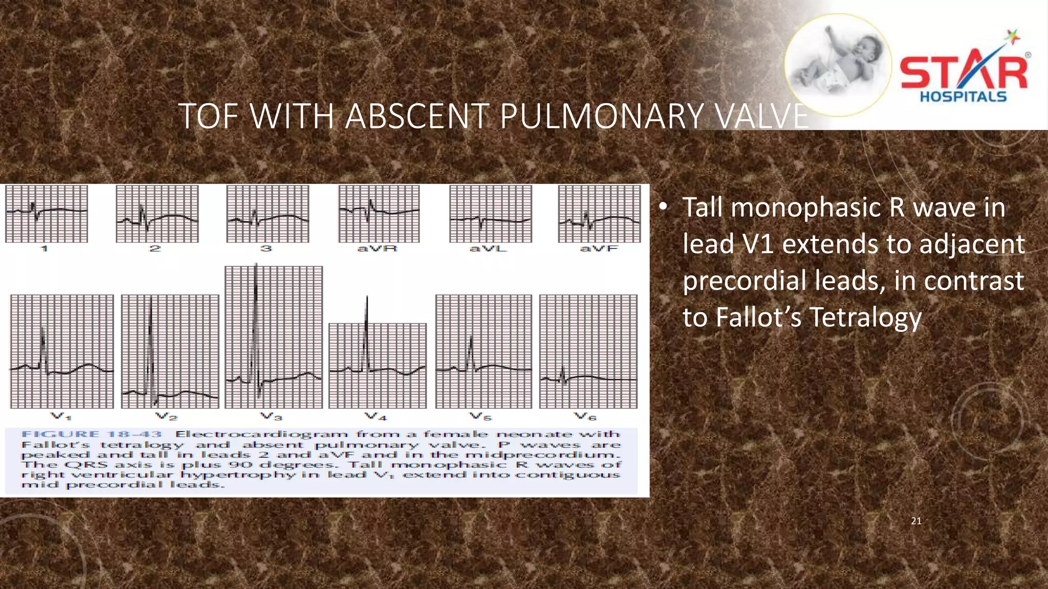 PEDIATRIC ECG, ECG IN CONGENITAL HEART DISEASES | PPTX