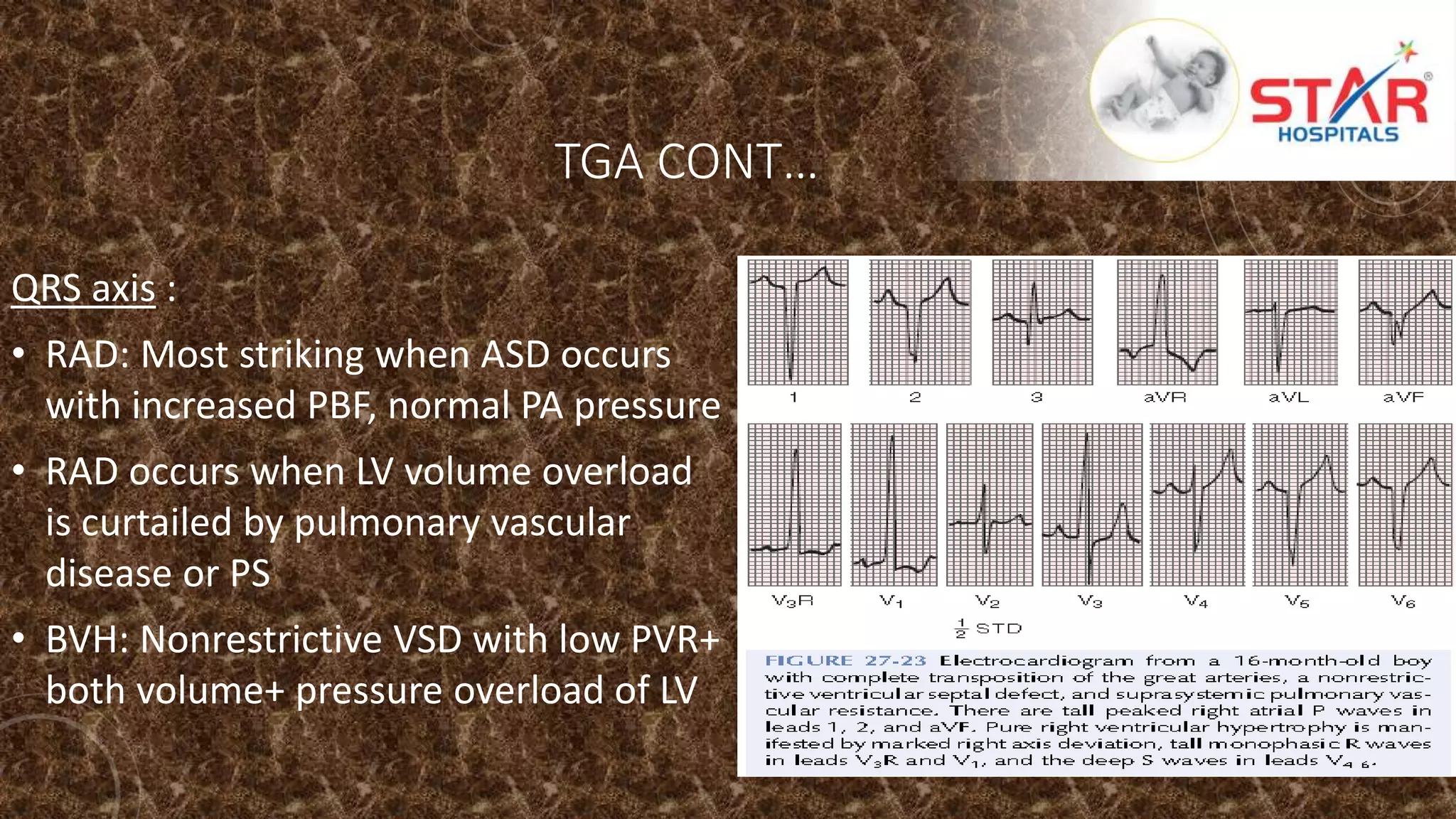 PEDIATRIC ECG, ECG IN CONGENITAL HEART DISEASES | PPTX