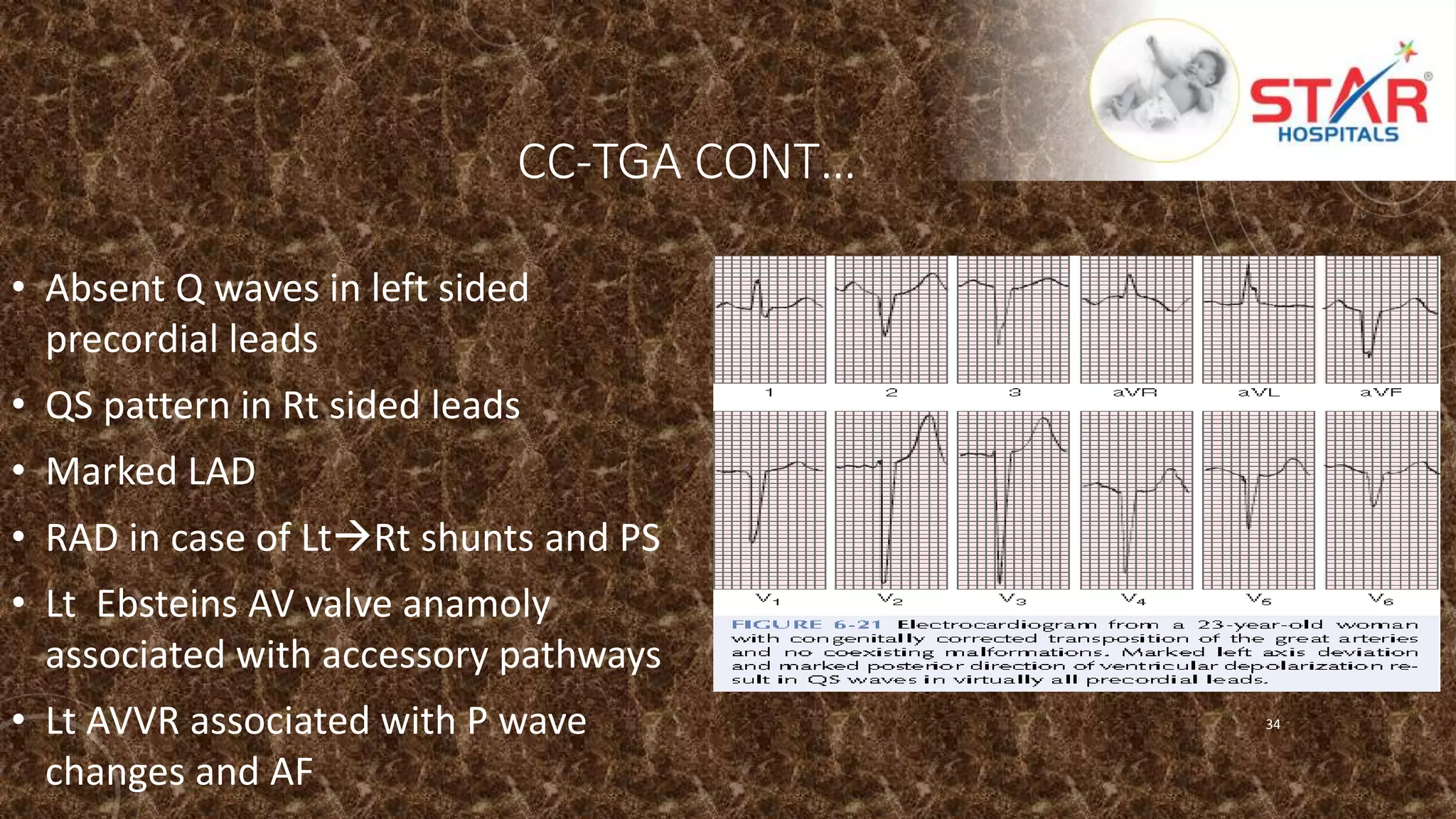 PEDIATRIC ECG, ECG IN CONGENITAL HEART DISEASES | PPTX