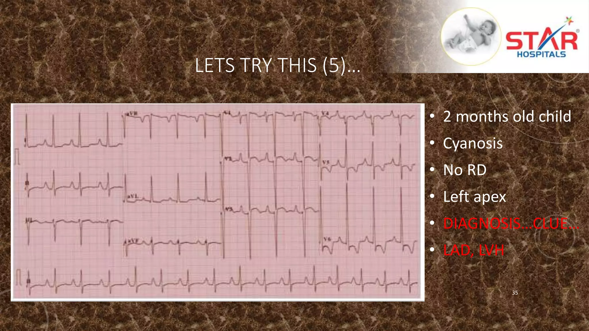 PEDIATRIC ECG, ECG IN CONGENITAL HEART DISEASES | PPTX
