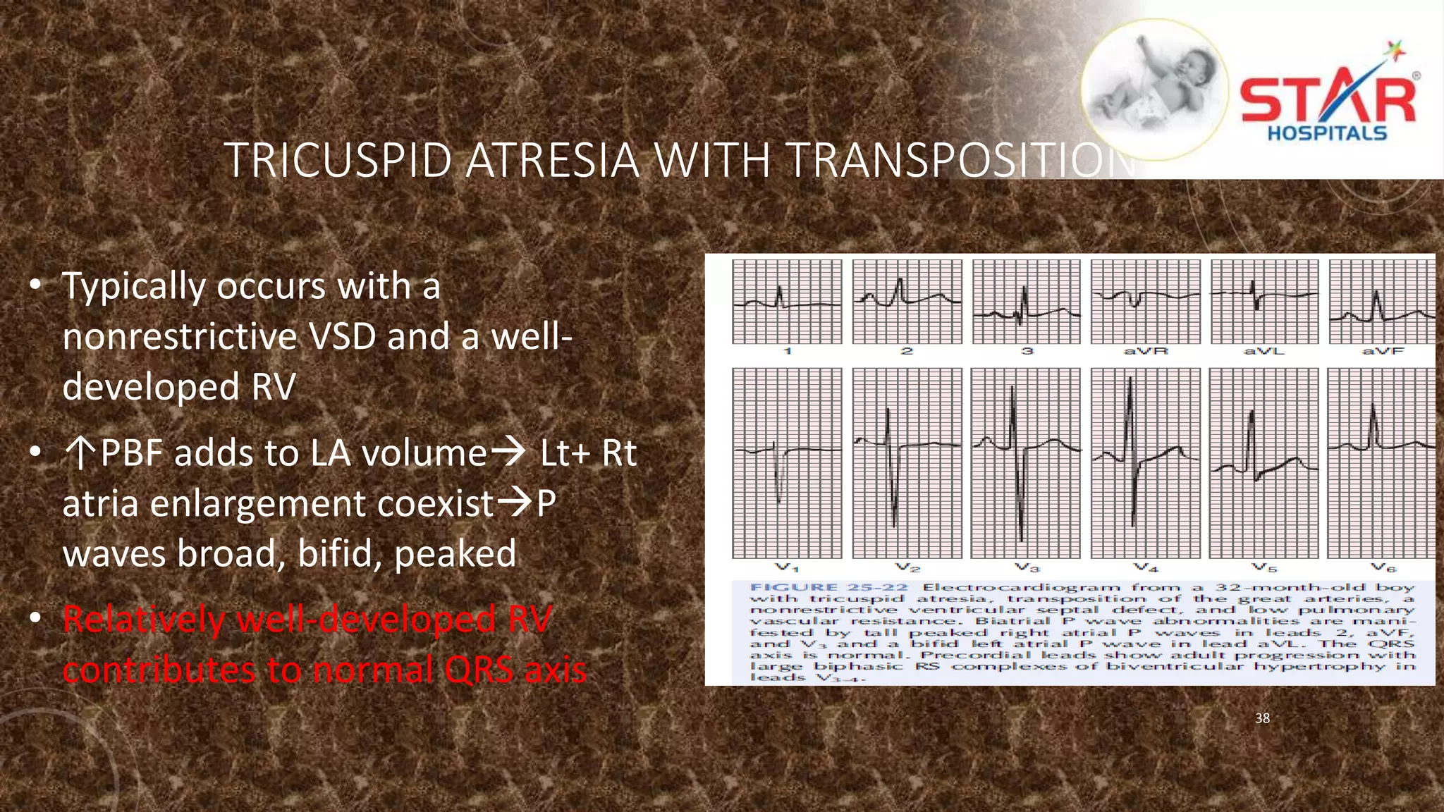 PEDIATRIC ECG, ECG IN CONGENITAL HEART DISEASES | PPTX