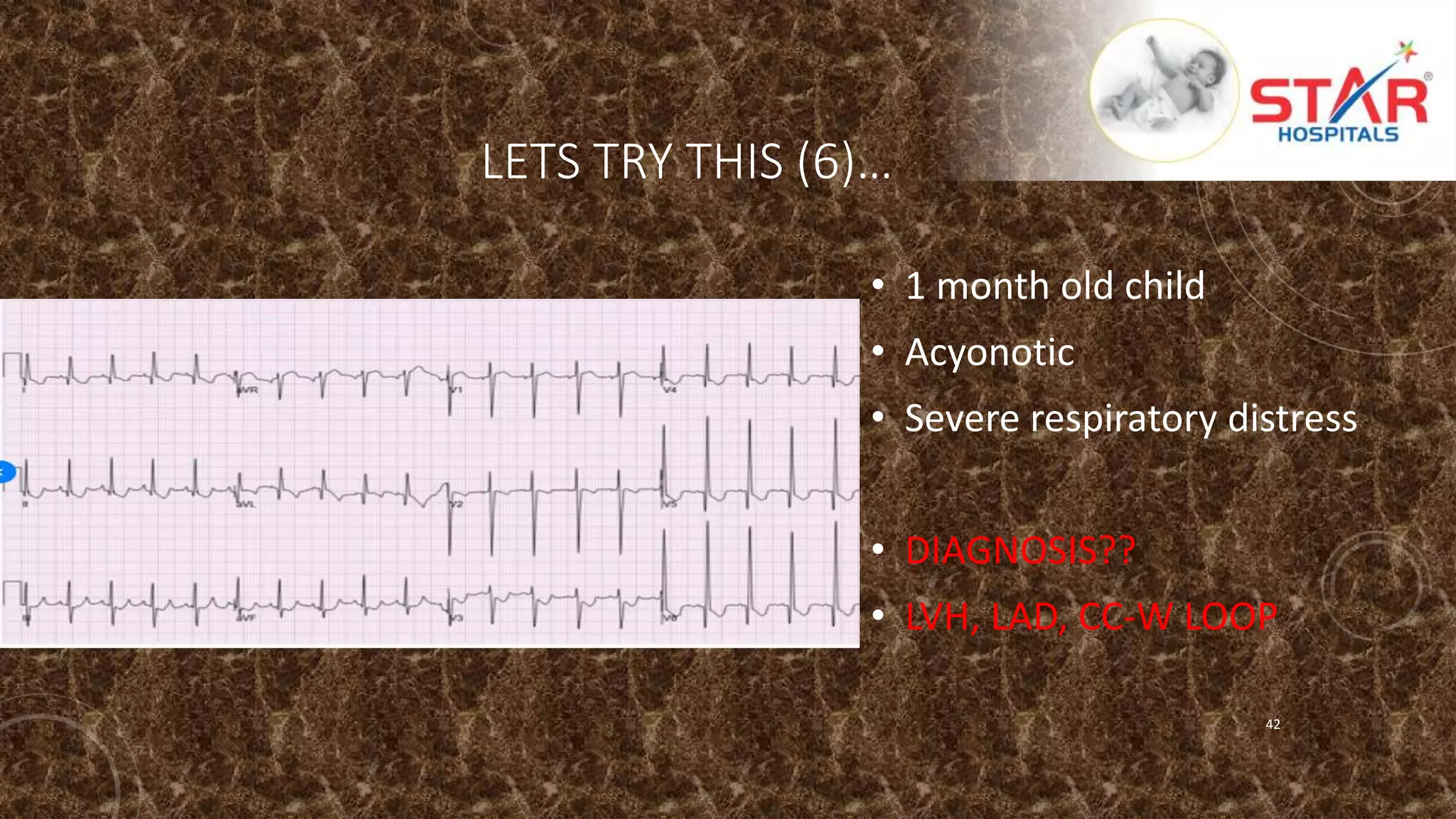 PEDIATRIC ECG, ECG IN CONGENITAL HEART DISEASES | PPTX
