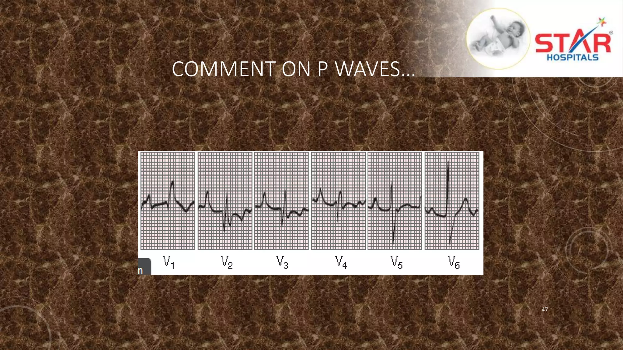 PEDIATRIC ECG, ECG IN CONGENITAL HEART DISEASES | PPTX
