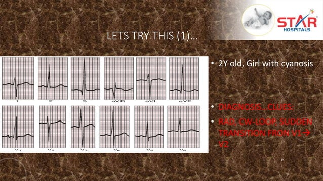 PEDIATRIC ECG, ECG IN CONGENITAL HEART DISEASES | PPTX