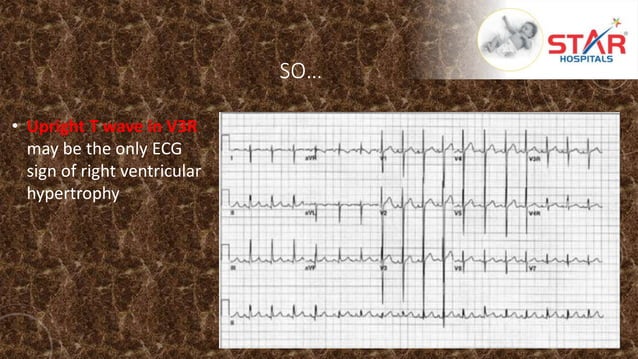PEDIATRIC ECG, ECG IN CONGENITAL HEART DISEASES | PPTX
