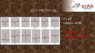 PEDIATRIC ECG, ECG IN CONGENITAL HEART DISEASES | PPTX