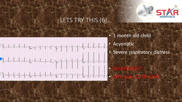 PEDIATRIC ECG, ECG IN CONGENITAL HEART DISEASES | PPTX