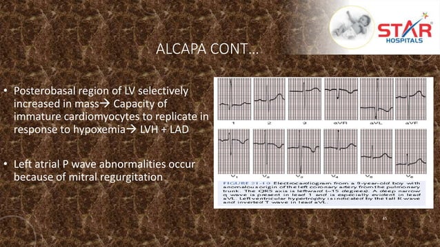 PEDIATRIC ECG, ECG IN CONGENITAL HEART DISEASES | PPTX