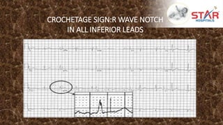 PEDIATRIC ECG, ECG IN CONGENITAL HEART DISEASES | PPTX