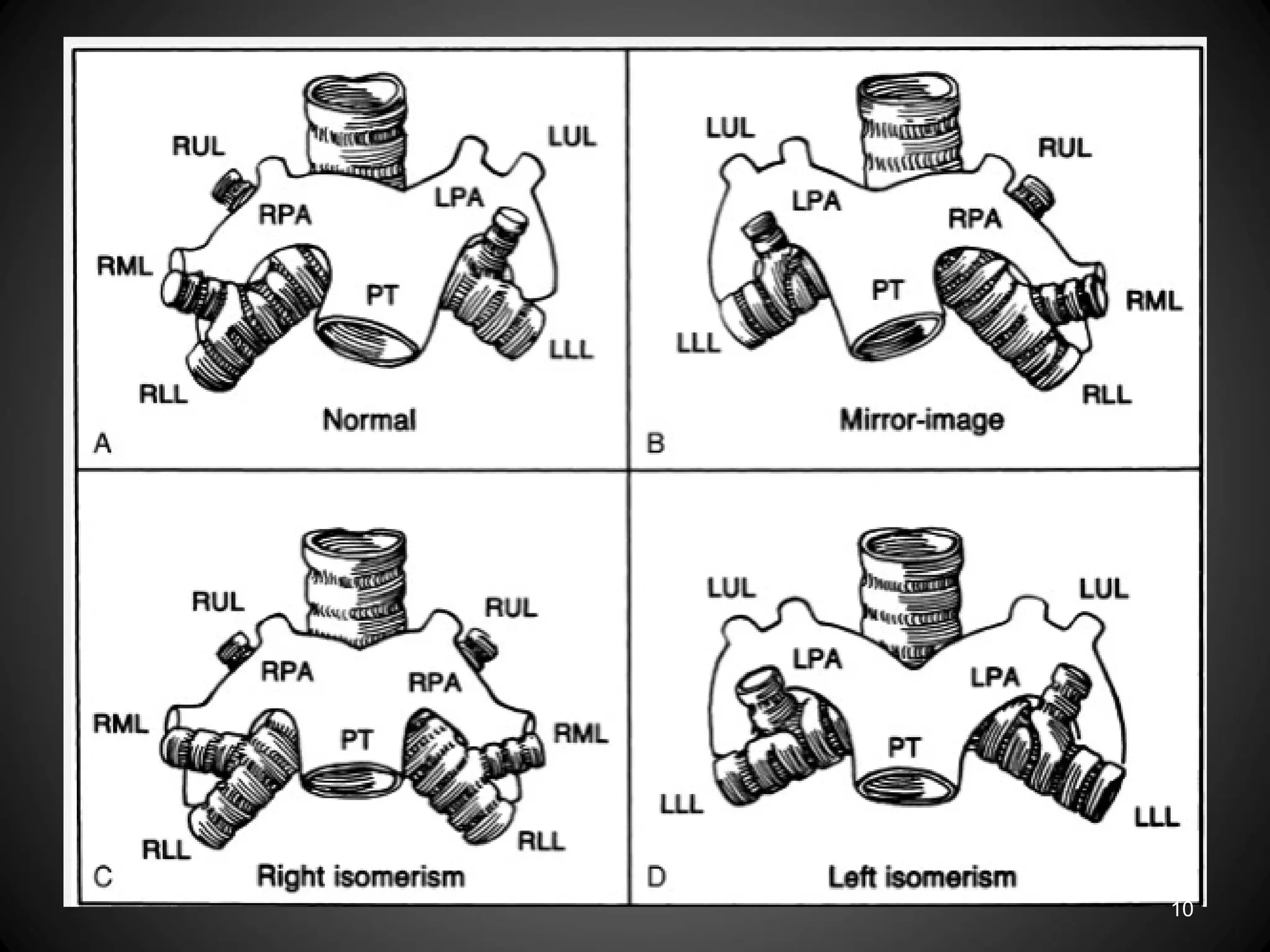 SEGMENTAL ANALYSIS OF CONGENITAL HEART DISEASE | PPT