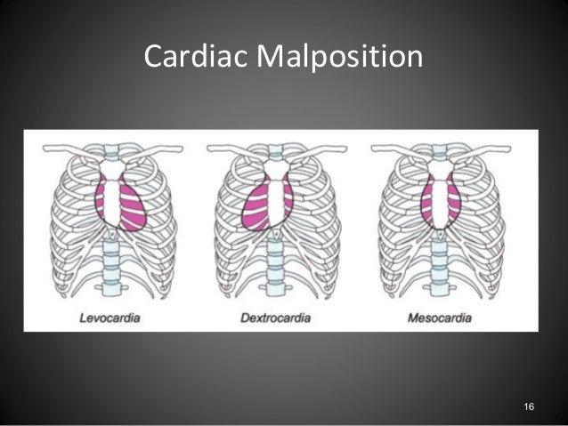 Pin by Marissa Mathenia on ECHO | Congenital heart disease, Congenital ...