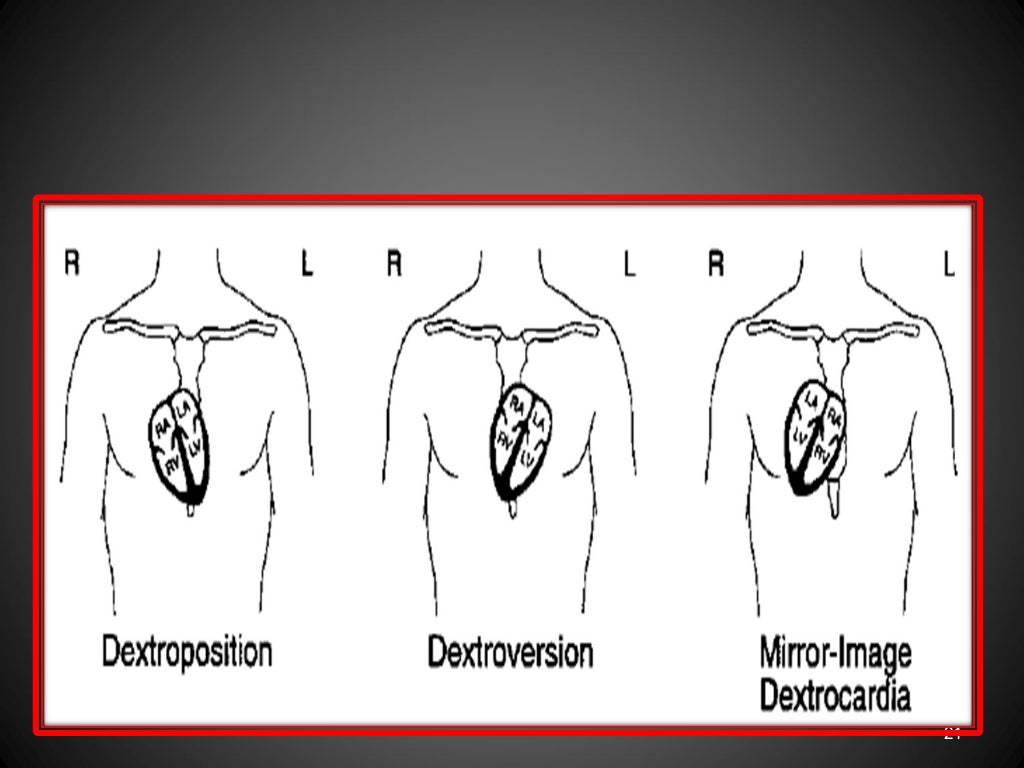 SEGMENTAL ANALYSIS OF CONGENITAL HEART DISEASE