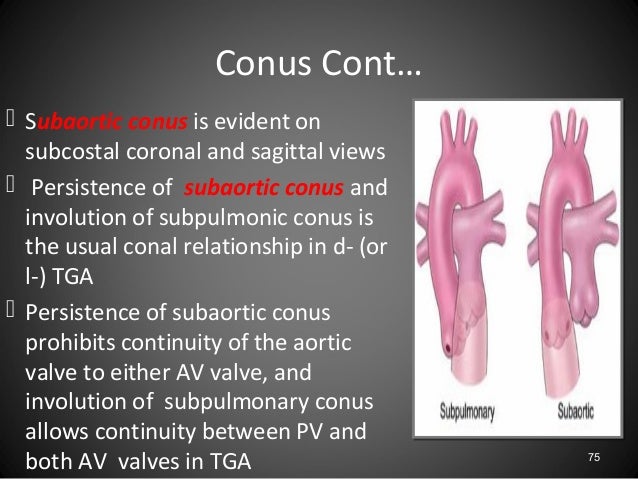 SEGMENTAL ANALYSIS OF CONGENITAL HEART DISEASE