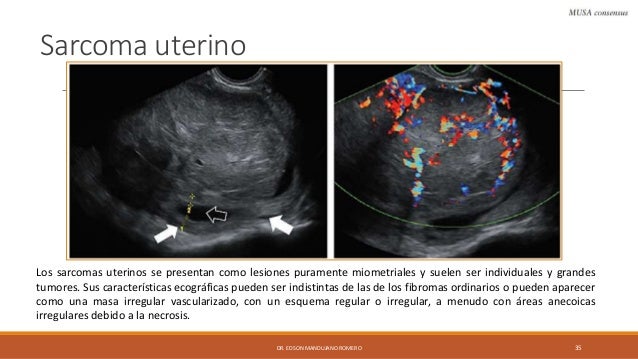 MUSA Evaluación ecográfica de morfología uterina