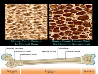 Muscle and bone plasticity after spinal cord injury | PPT