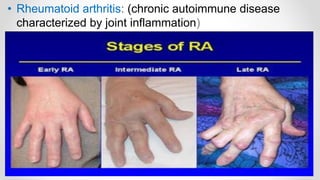 skeletal Muscle atrophy | PPT