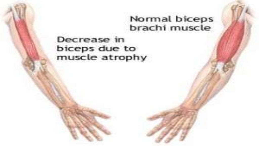 skeletal Muscle atrophy