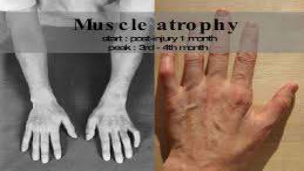 skeletal Muscle atrophy
