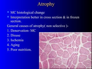 Muscle Atrophy Histology